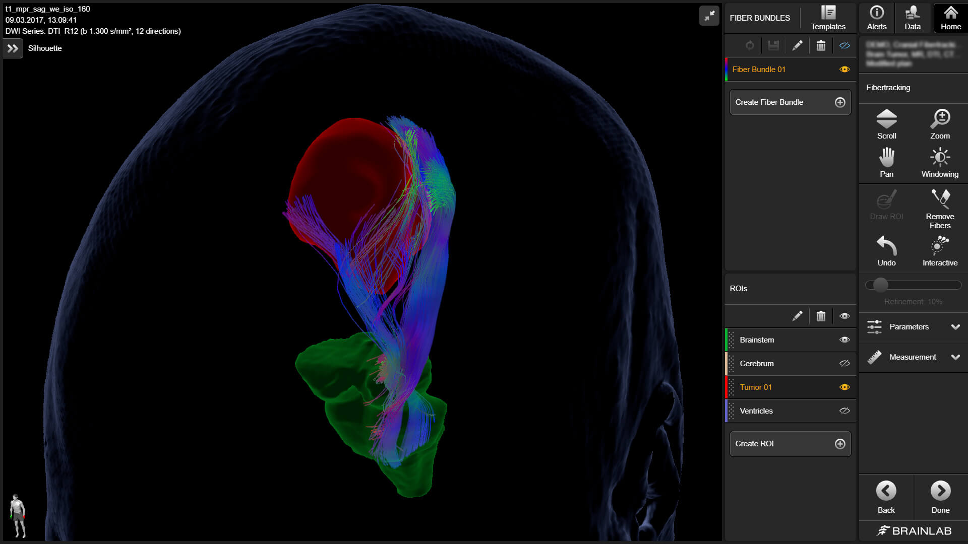 Elements Fibertracking | Brainlab